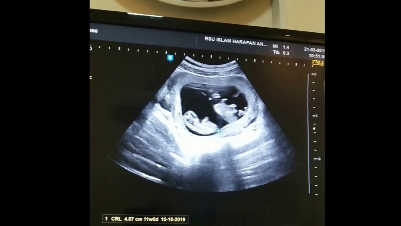 Arti Mimpi Melihat Bayi Kembar menurut Agama, Psikologi dan Primbon Jawa